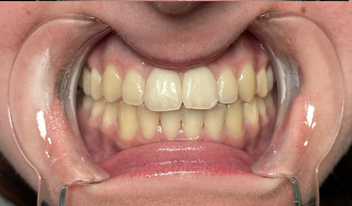 #1 Teeth Whitening Franchise- Naturally White